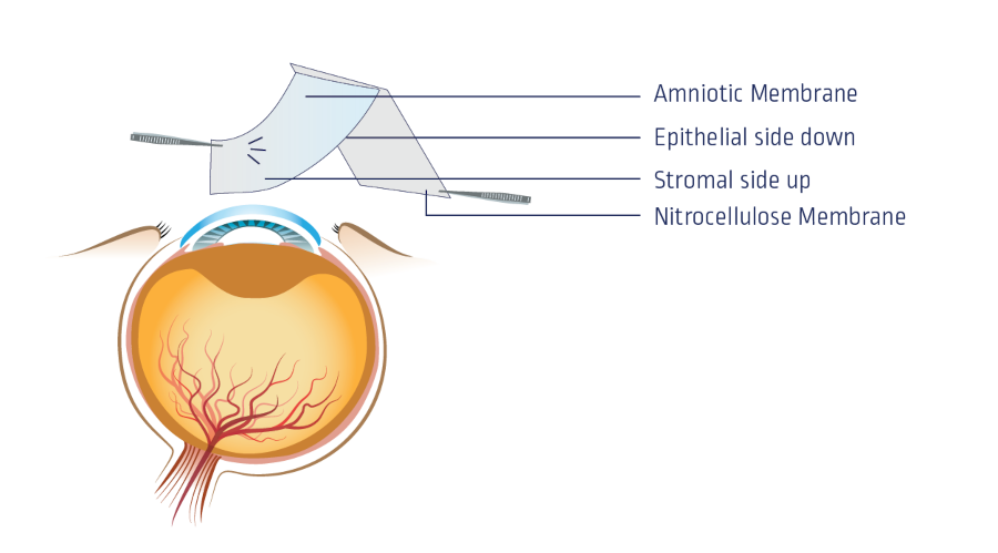 AmnioMatrix - Amniotic Membrane for Ophthalmology - Next Biosciences