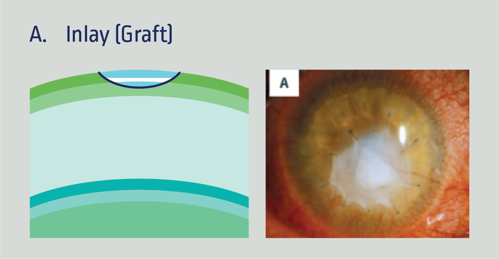 AmnioMatrix - Amniotic Membrane for Ophthalmology - Next Biosciences