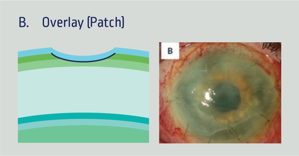 AmnioMatrix - Amniotic Membrane for Ophthalmology - Next Biosciences